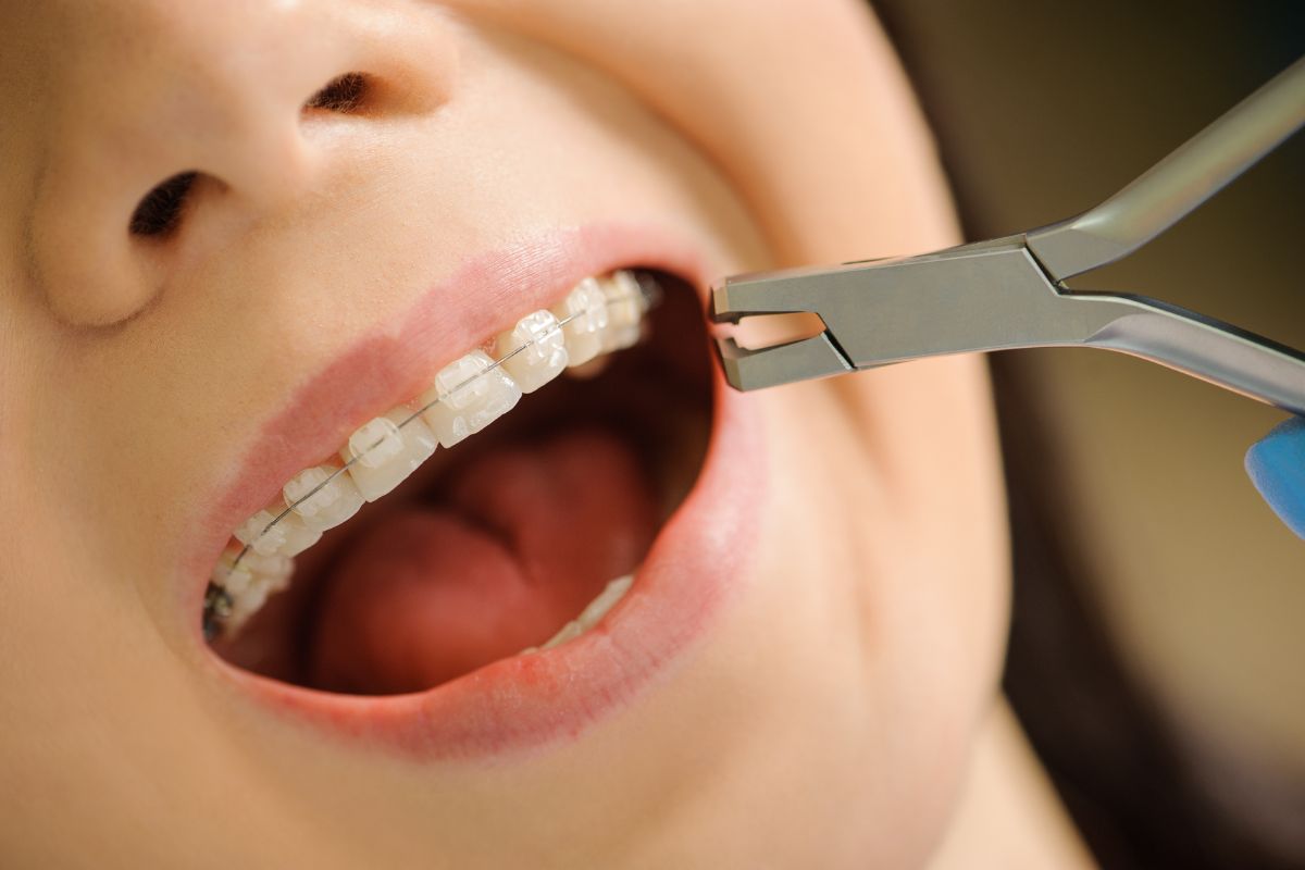 The Science Behind the Carriere Appliance for Faster Orthodontics